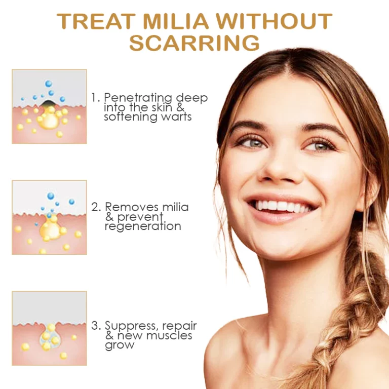 Speedy Milia Removal Treatment - Not Sold In Stores
