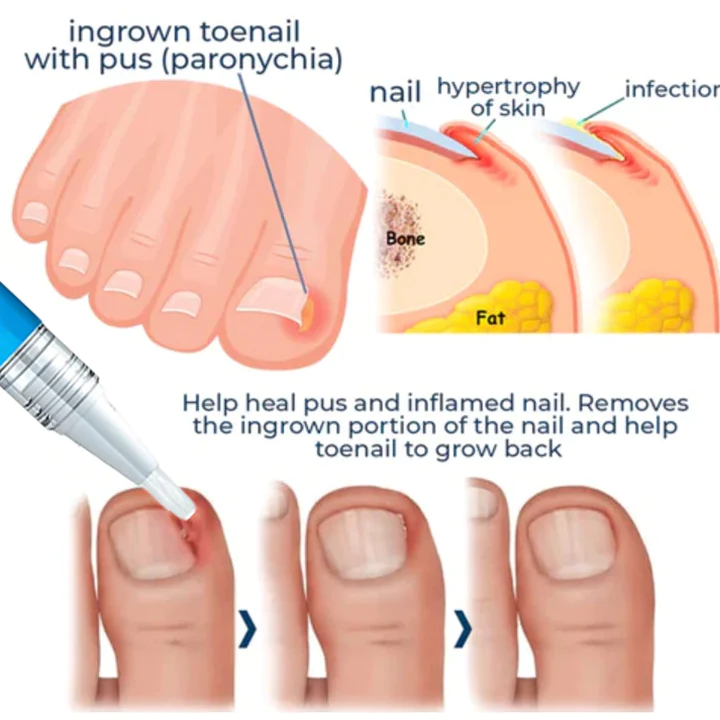 CC™ Removal Paronychia Gel - Not Sold In Stores